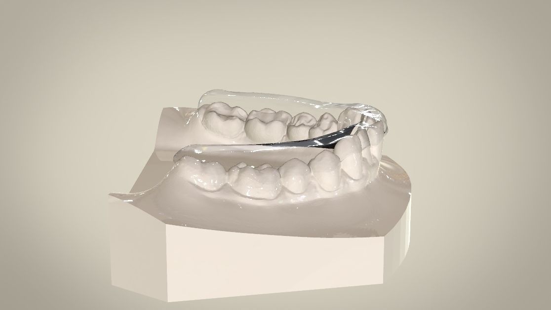 Digital Flat Occlusal Plane Splint 3D model 3D printable | CGTrader