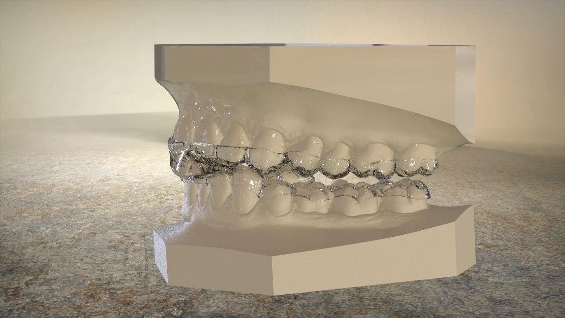 3D Dawson B Splints 3D model 3D printable | CGTrader