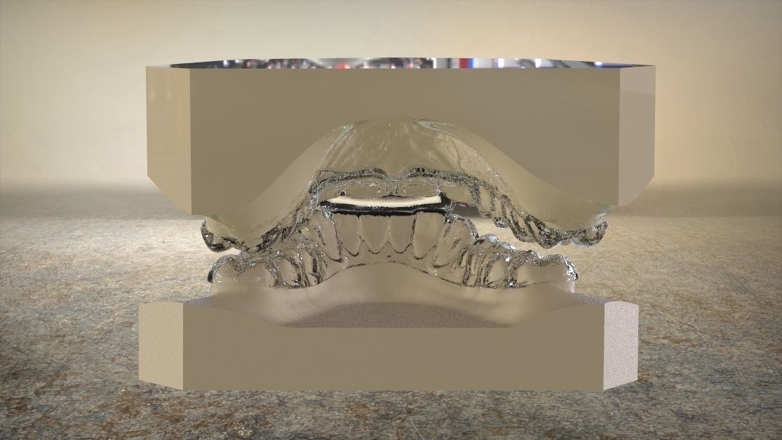 3D Dawson B Splints 3D model 3D printable | CGTrader