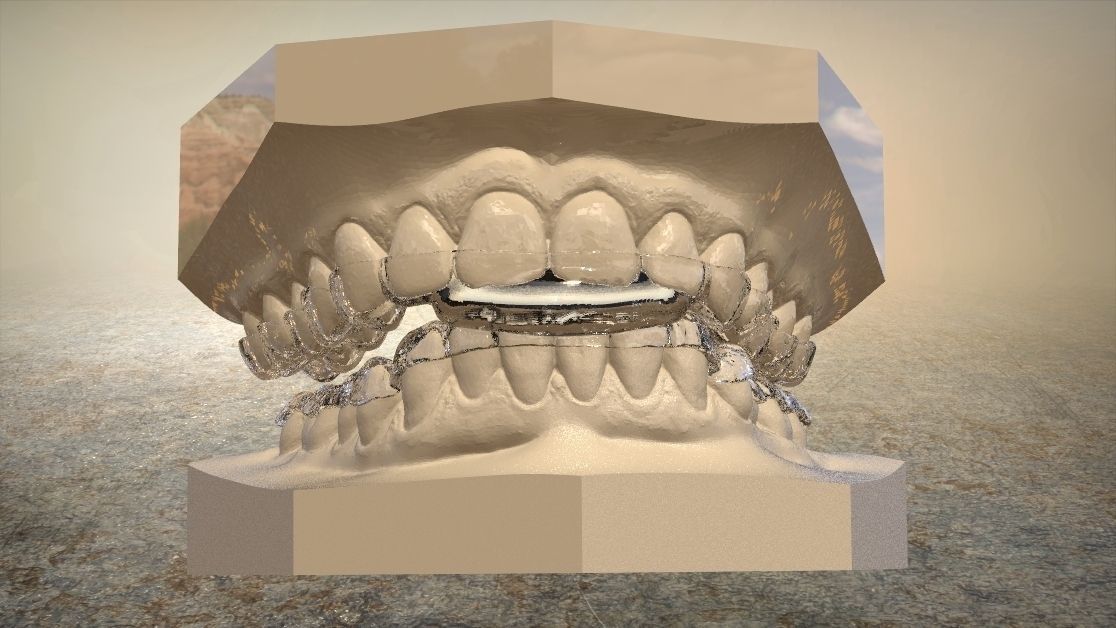 3D Dawson B Splints 3D model 3D printable | CGTrader