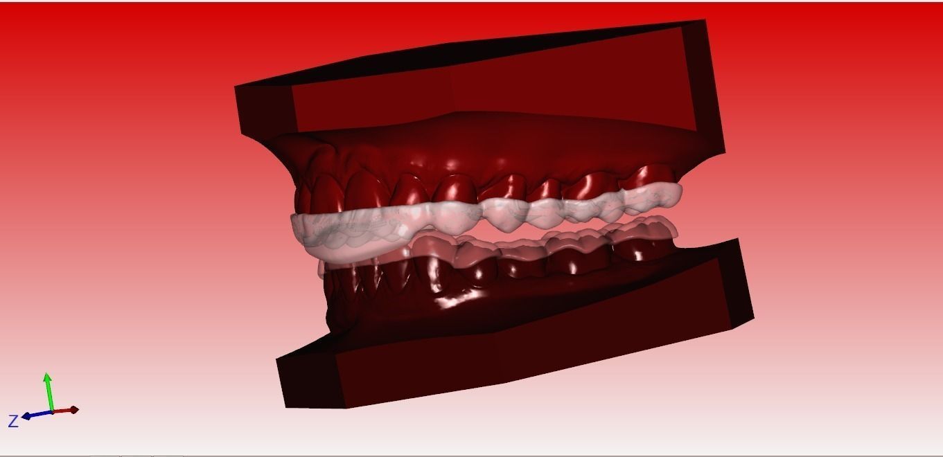 3D Dawson B Splints 3D model 3D printable | CGTrader