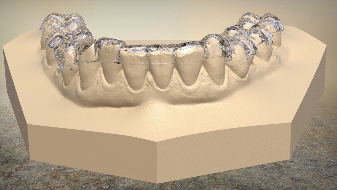 3D Dawson B Splints 3D model 3D printable | CGTrader