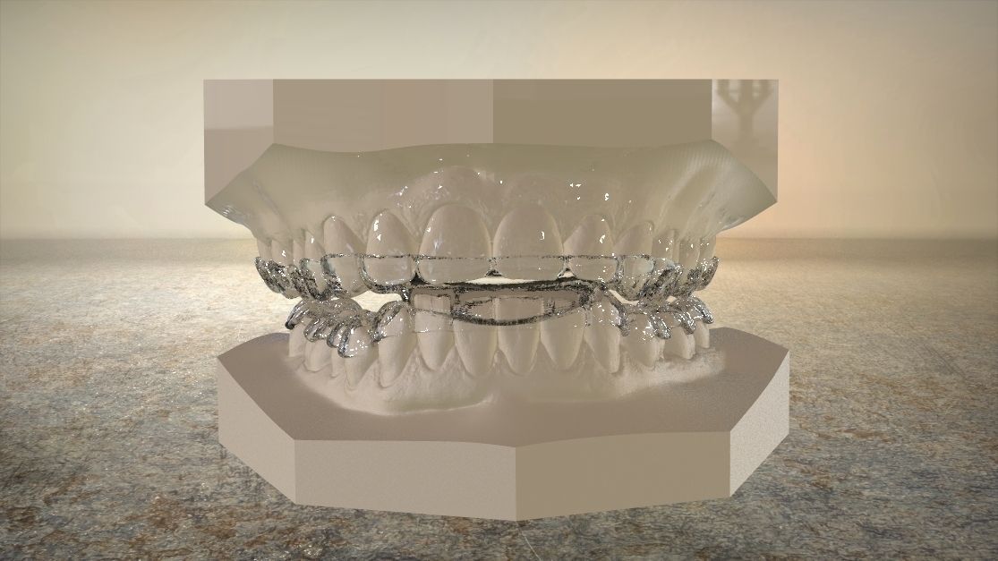 3D Dawson B Splints 3D model 3D printable | CGTrader