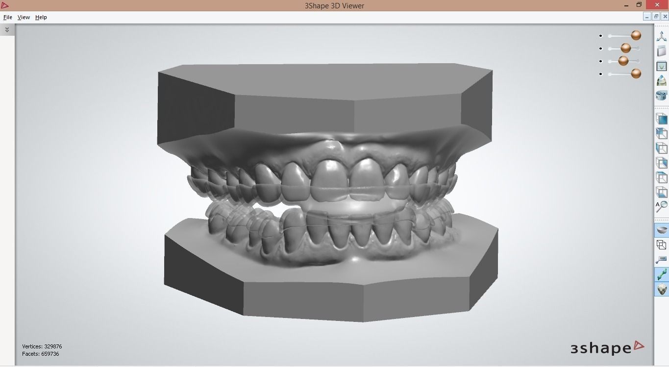3D Dawson B Splints 3D model 3D printable | CGTrader