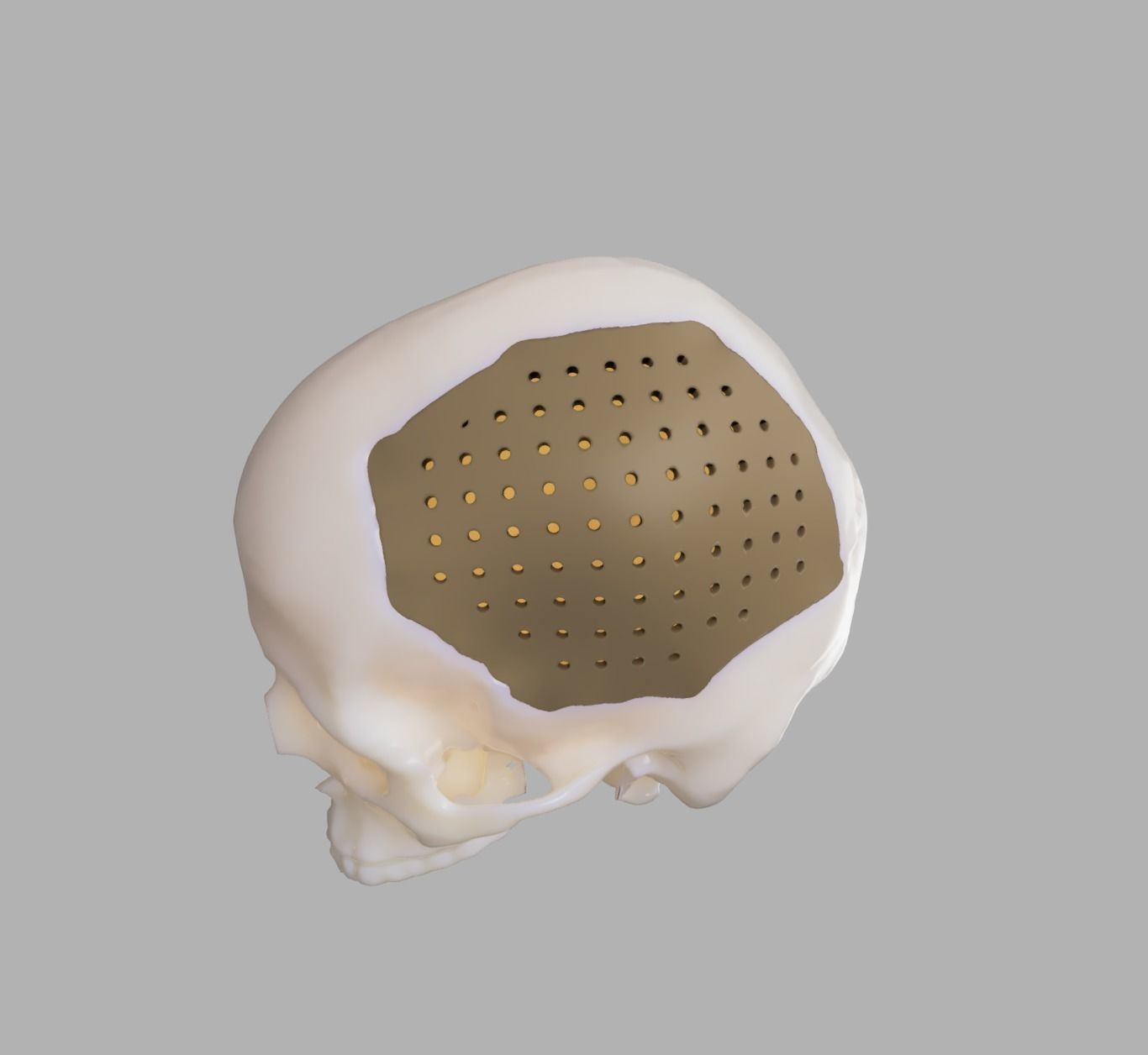 Cranium with defect and prosthesis 3D model 3D printable | CGTrader