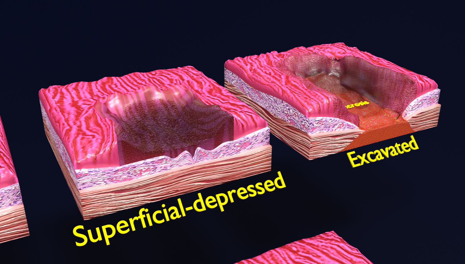 Gastric stomach cancer stages labelled 3D model | CGTrader