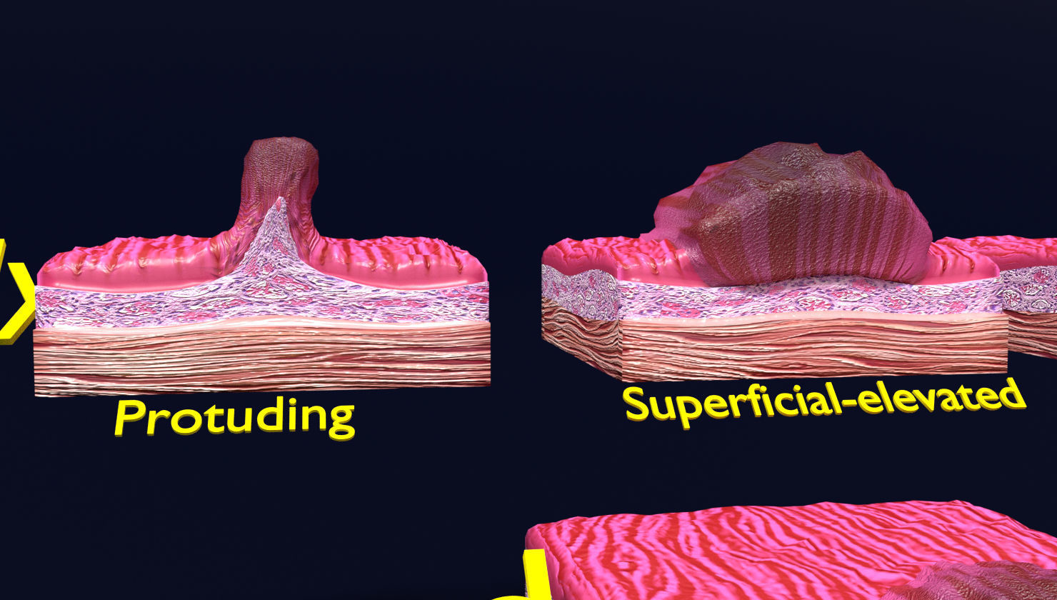 Gastric stomach cancer stages labelled 3D model | CGTrader