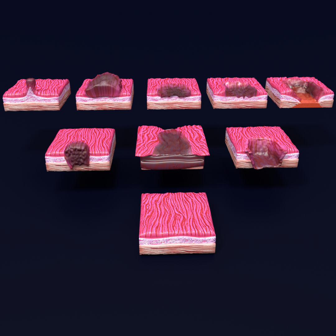 Gastric stomach cancer stages labelled 3D model | CGTrader