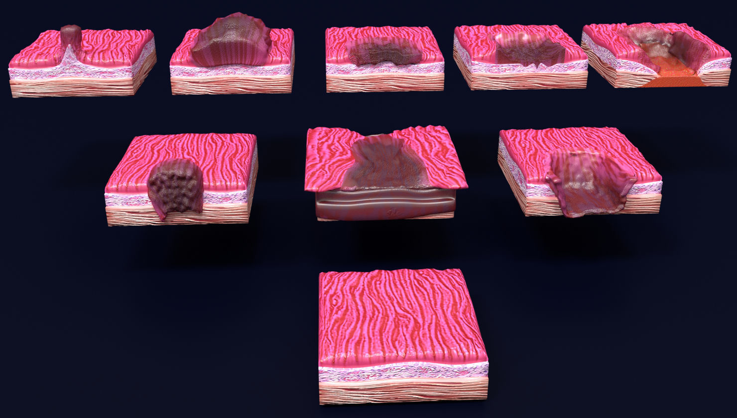Gastric stomach cancer stages labelled 3D model | CGTrader