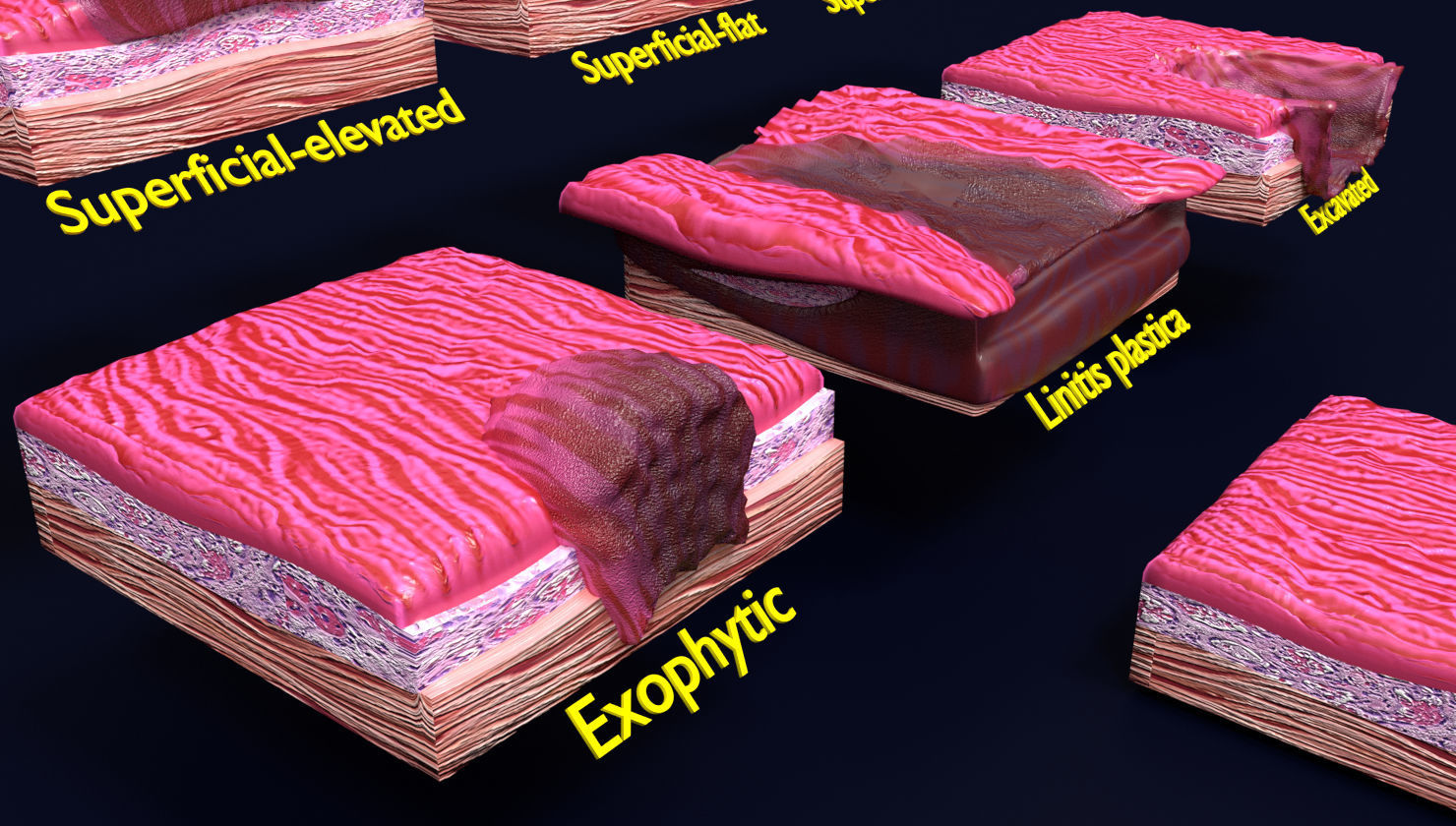 Gastric stomach cancer stages labelled 3D model | CGTrader