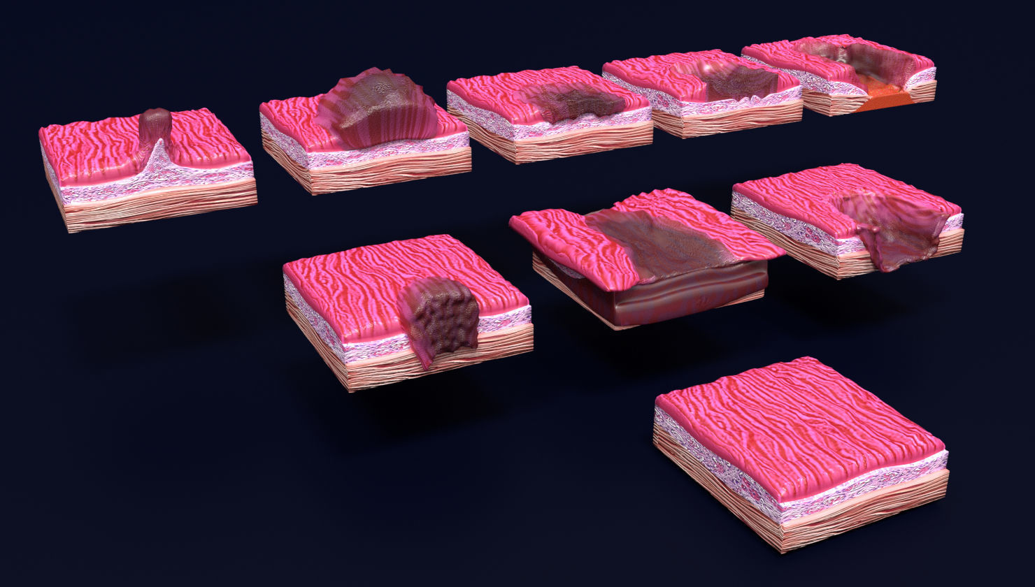 Gastric stomach cancer stages labelled 3D model | CGTrader