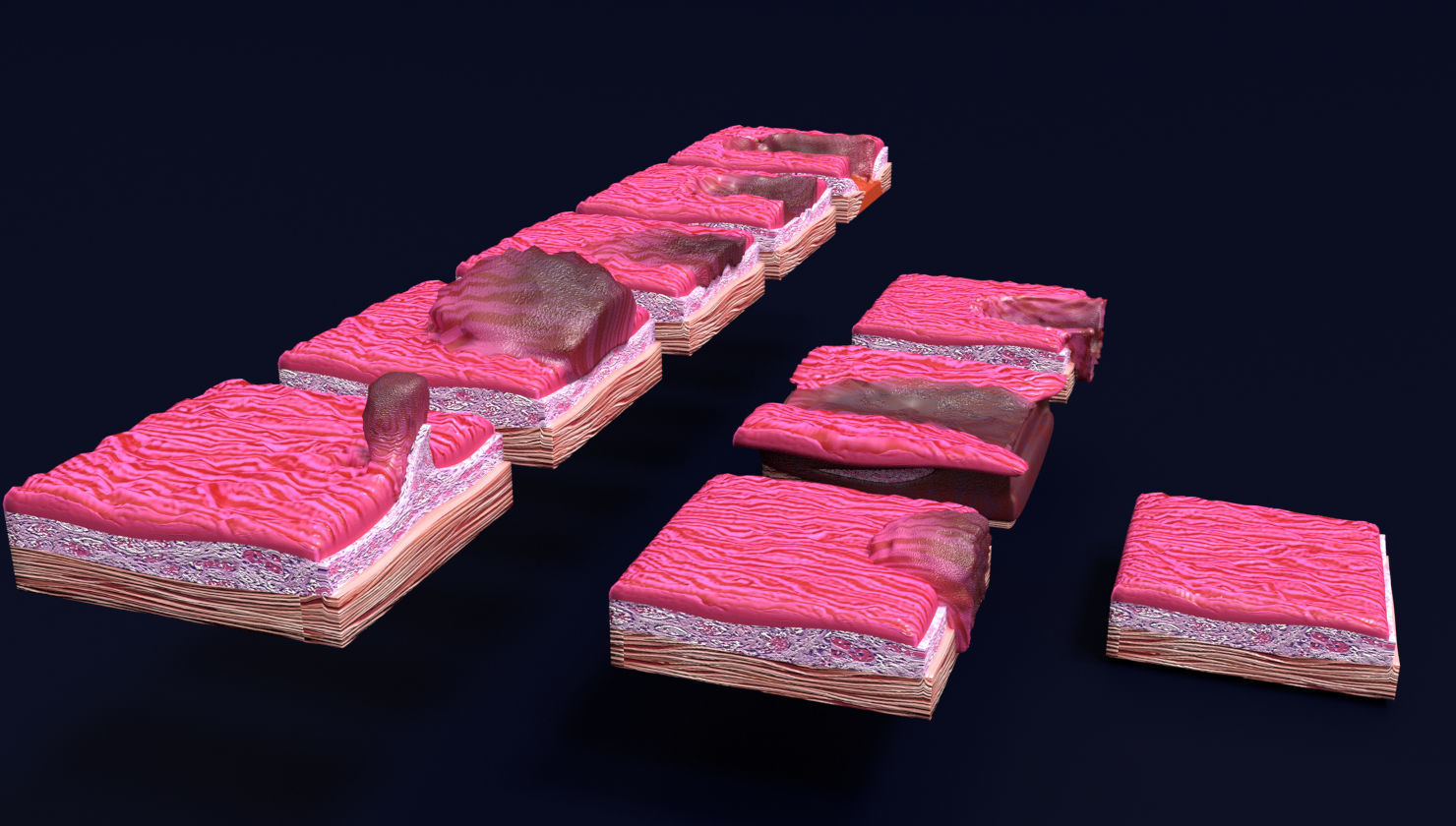 Gastric stomach cancer stages labelled 3D model | CGTrader