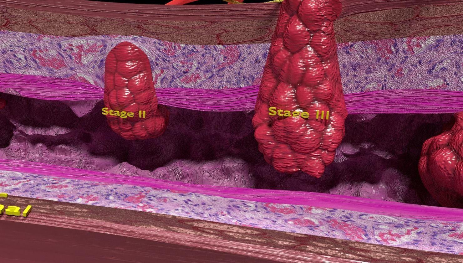 Colon cancer staging detail labelled 3D model | CGTrader