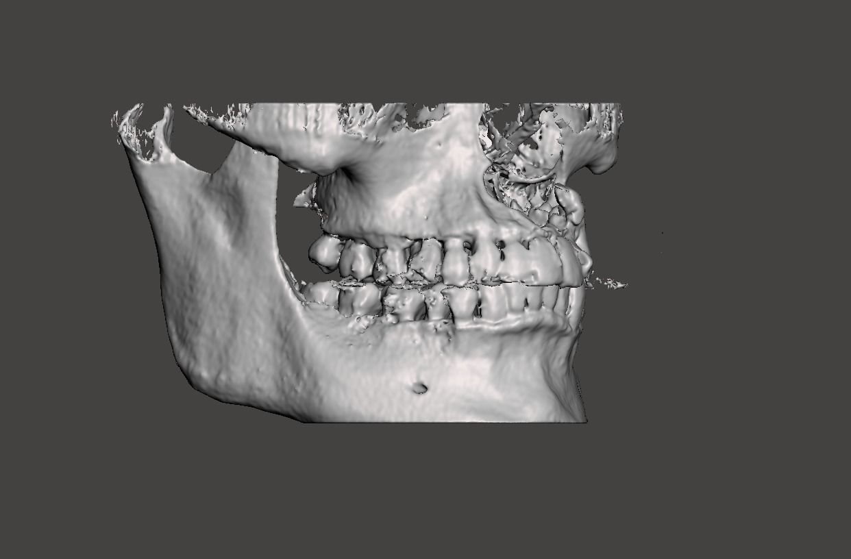 Left Maxillary Cystic Lesion with Impacted Supernumerary Tooth 3D model ...