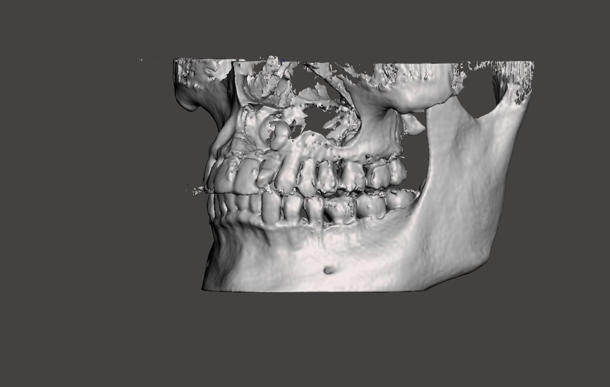 Left Maxillary Cystic Lesion with Impacted Supernumerary Tooth 3D model ...