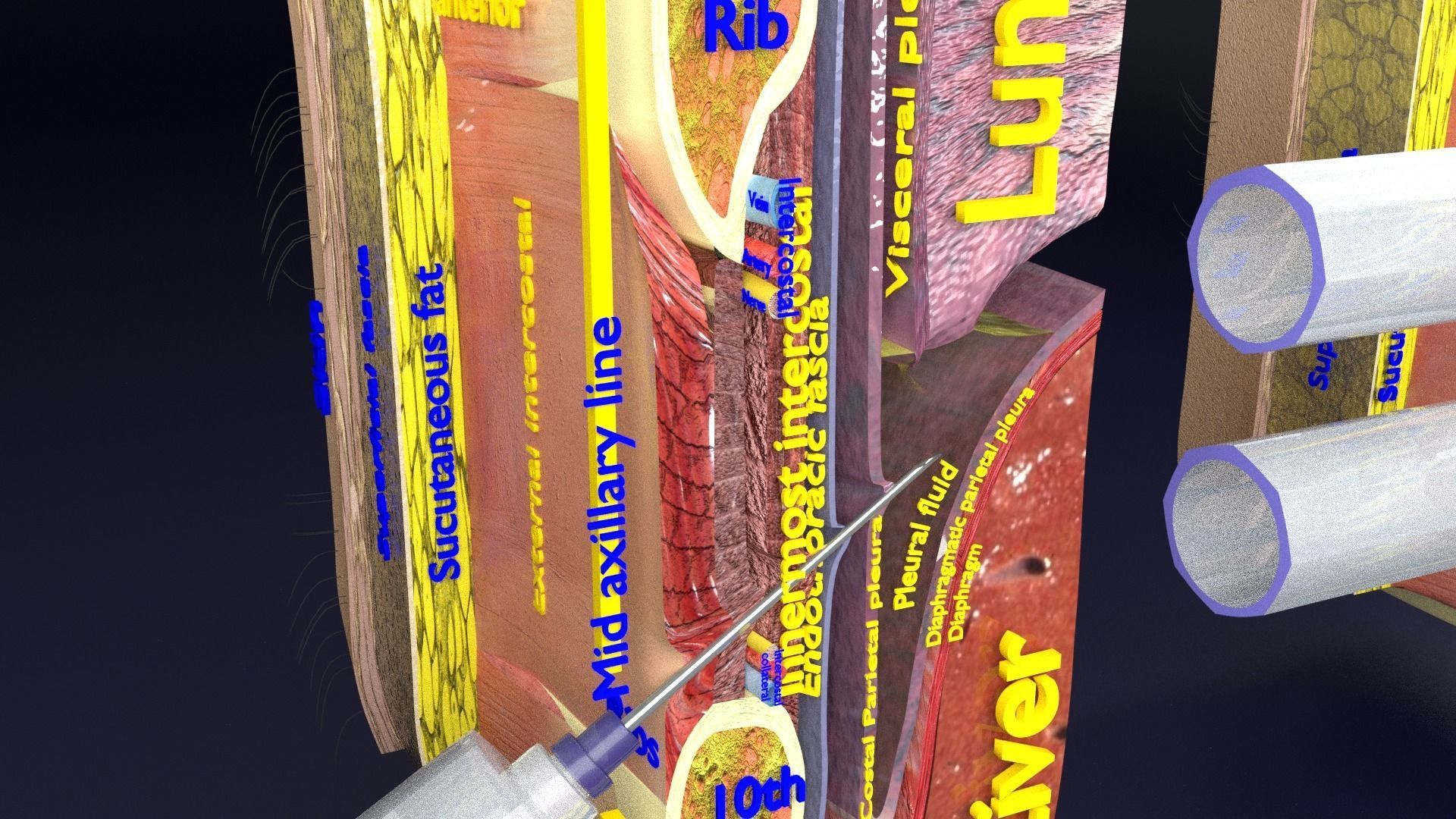 Thorax Thoracotomy Thoracocentesis Intercostal Nerve Block 3d Model
