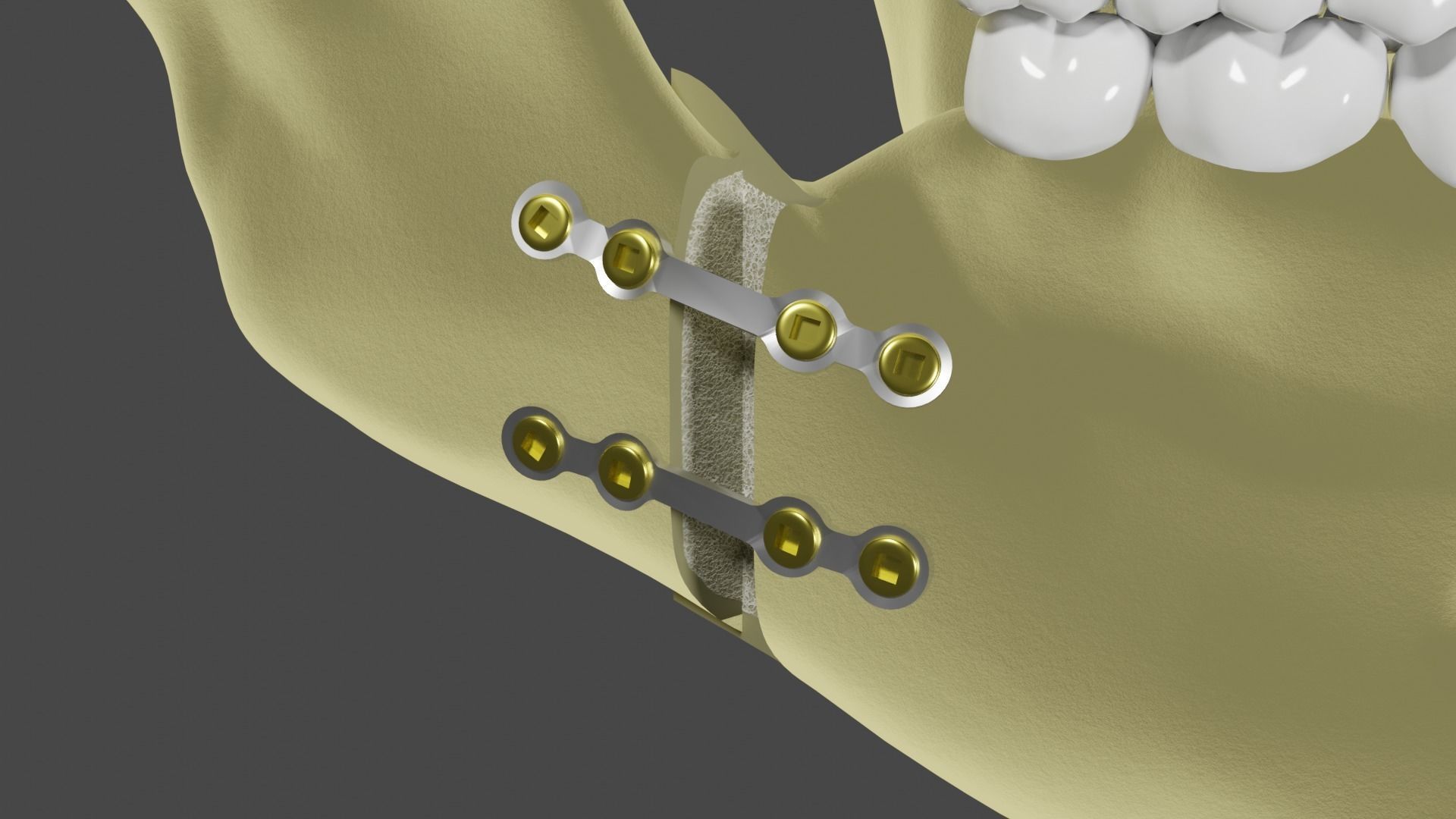 Orthognatic surgery - Titanium plates in the mandible 3D model | CGTrader
