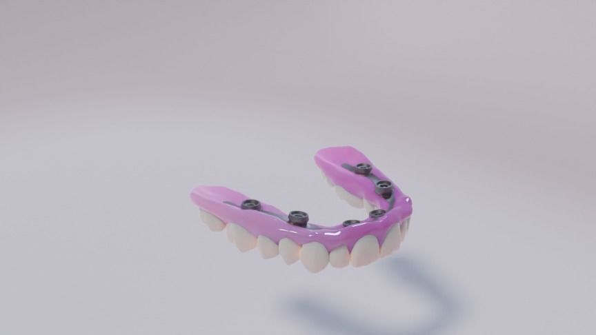 Full arch fixed implant-supported prostheses - Dental implant 3D model ...