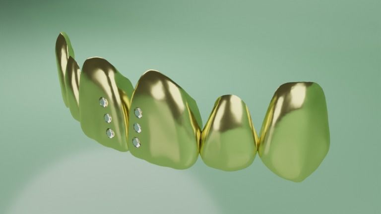 Grillz with diamonds in the front teeth 3D model | CGTrader