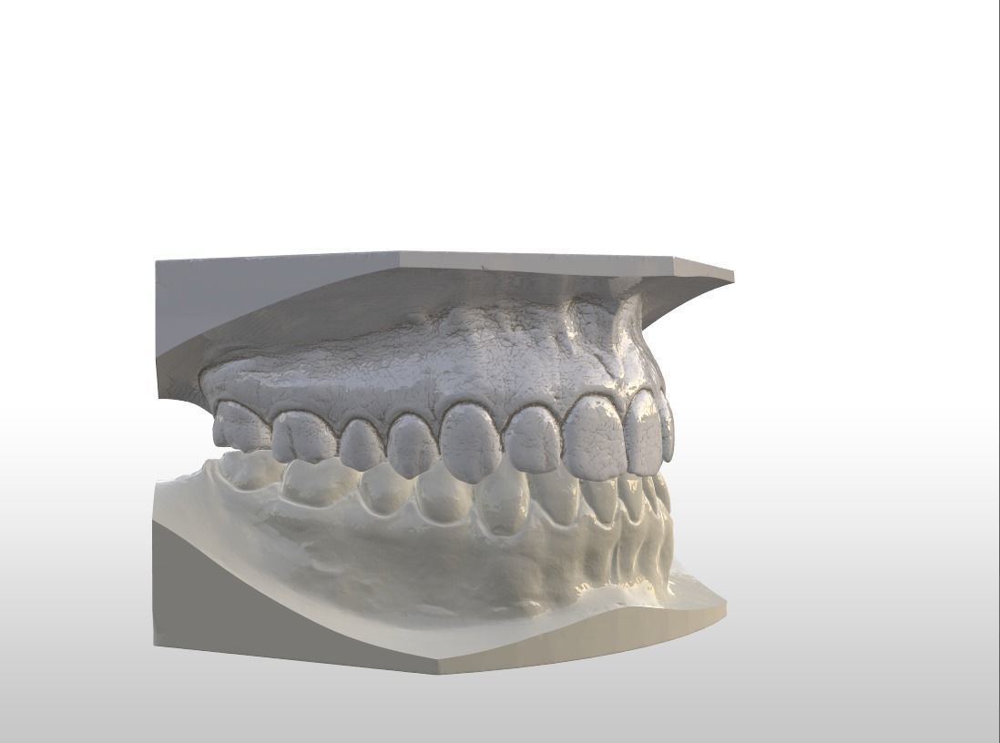 Full Coverage Occlusal Splint with Canine Guidance 3D model 3D ...