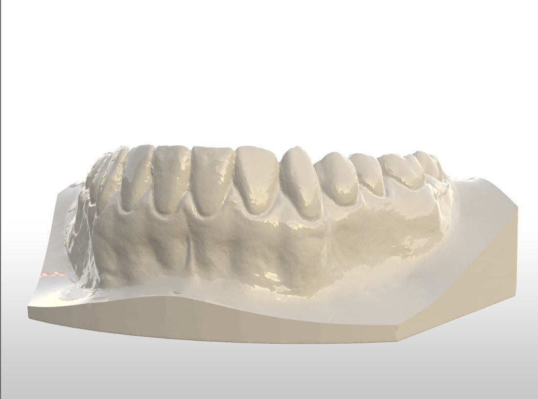 Full Coverage Occlusal Splint with Canine Guidance 3D model 3D ...