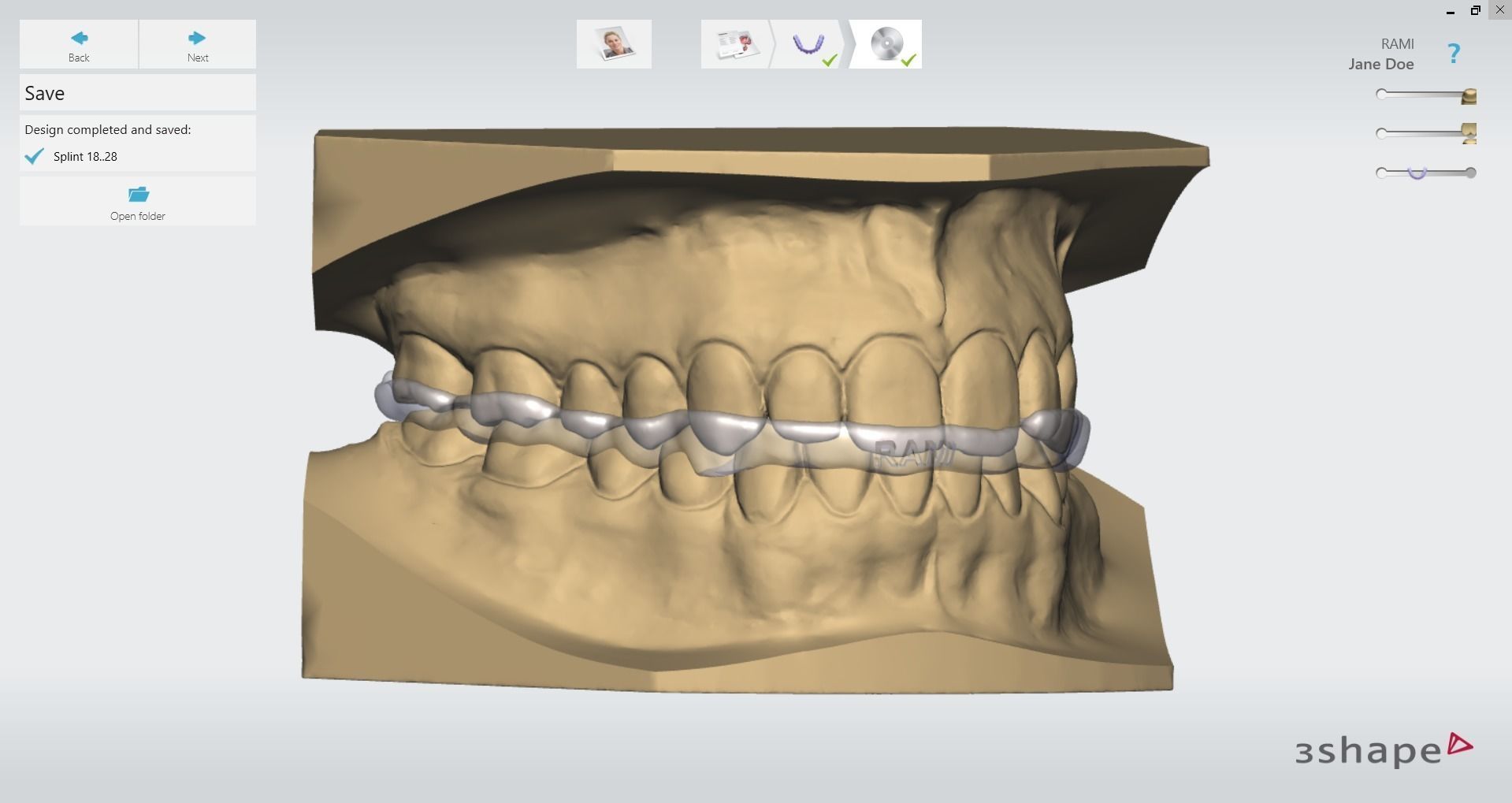 Full Coverage Occlusal Splint with Canine Guidance 3D model 3D ...