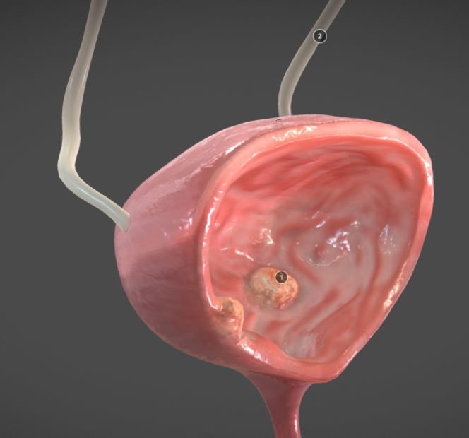 3D model Bladder cancer VR / AR / low-poly | CGTrader