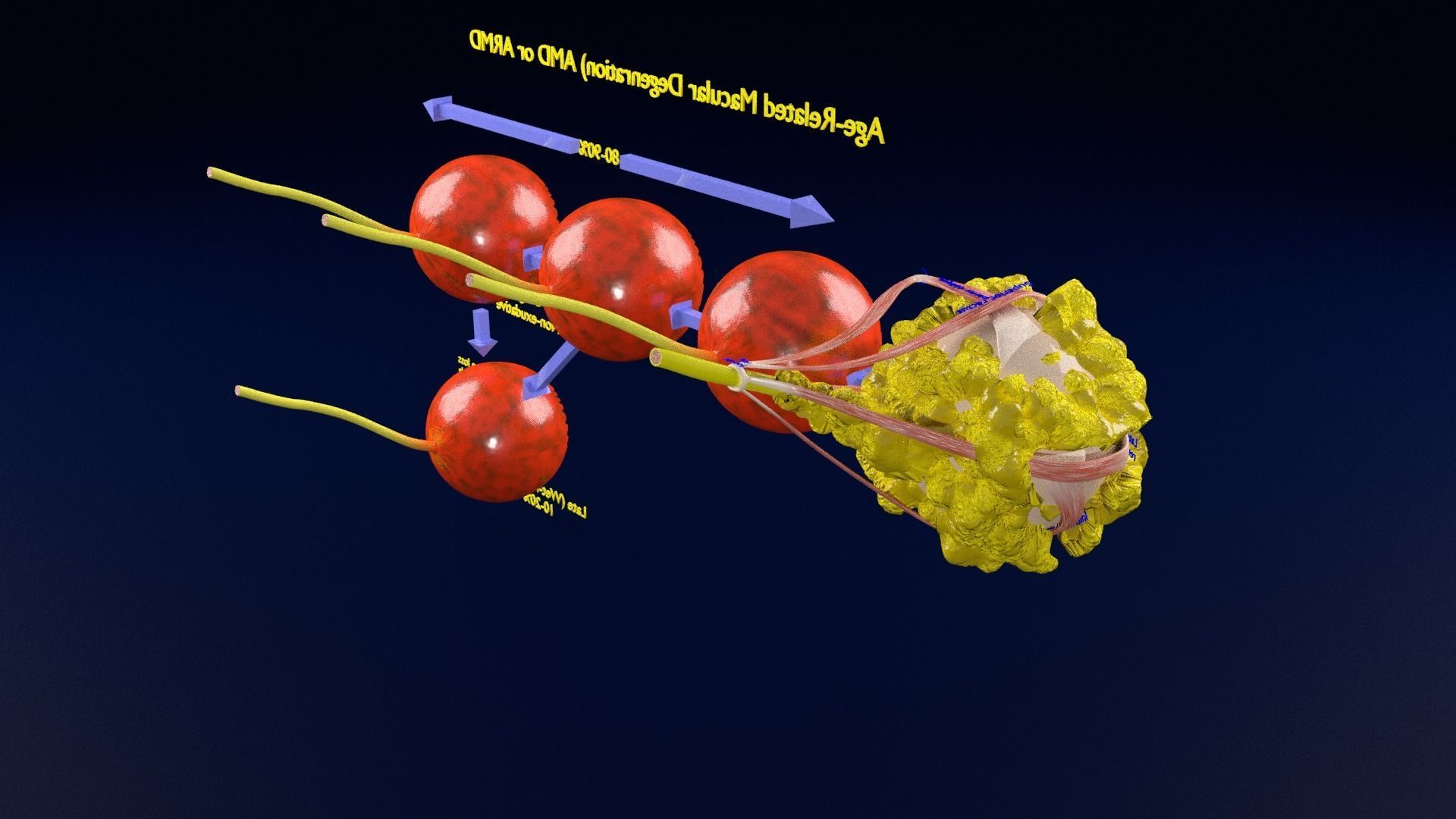 Age related macular degeneration AMD ARMD detailed labelled 3D model ...
