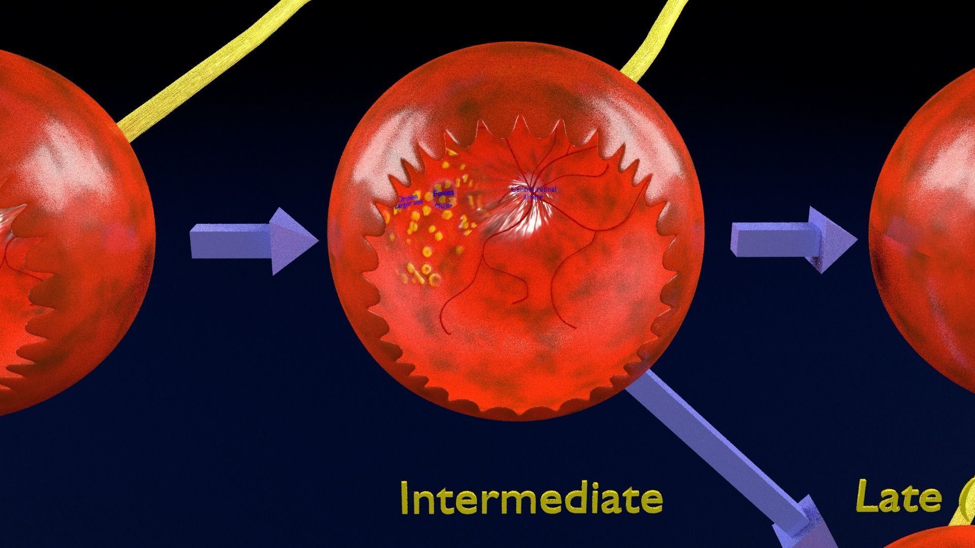 Age related macular degeneration AMD ARMD detailed labelled 3D model ...