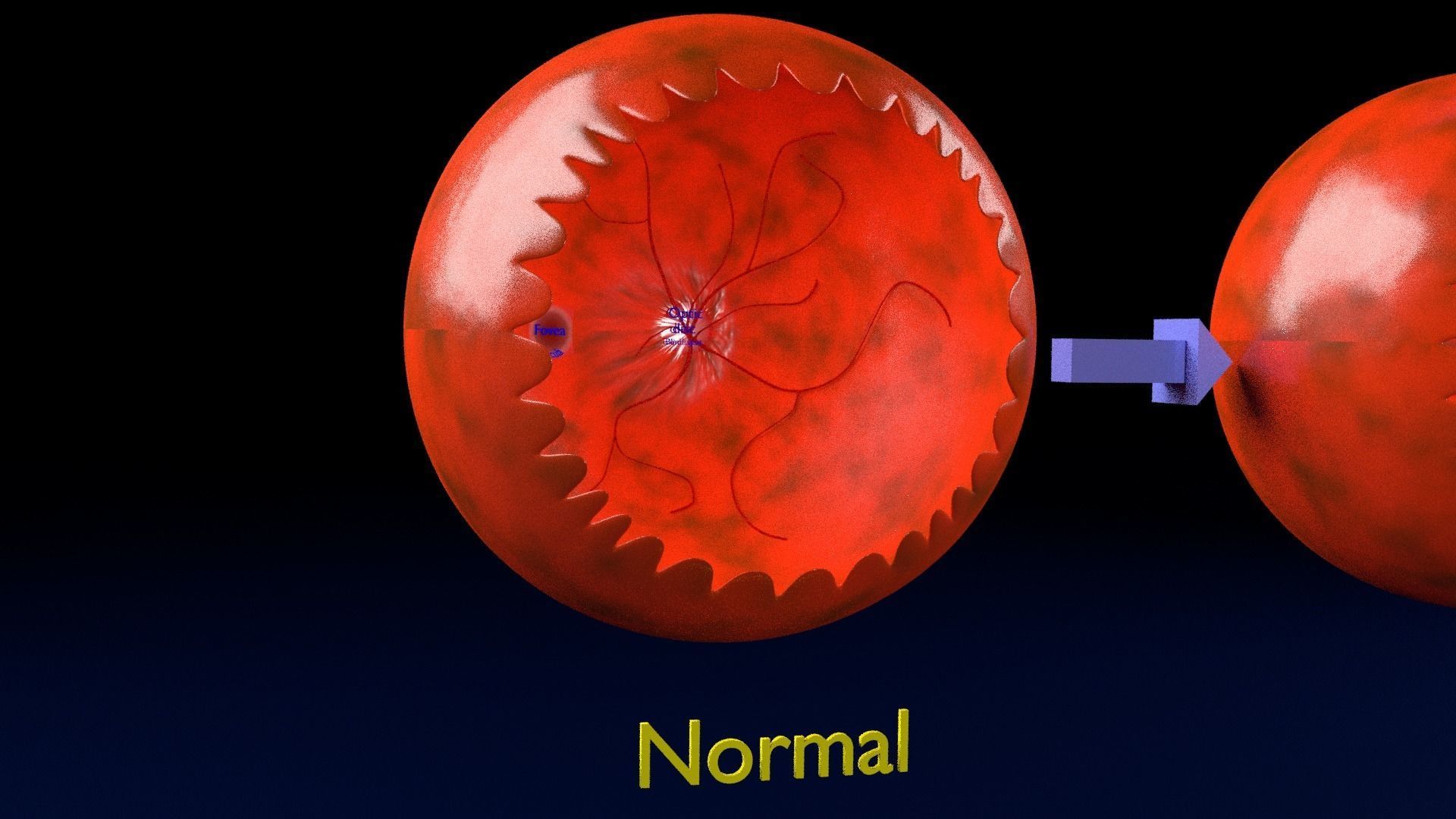 Age related macular degeneration AMD ARMD detailed labelled 3D model ...