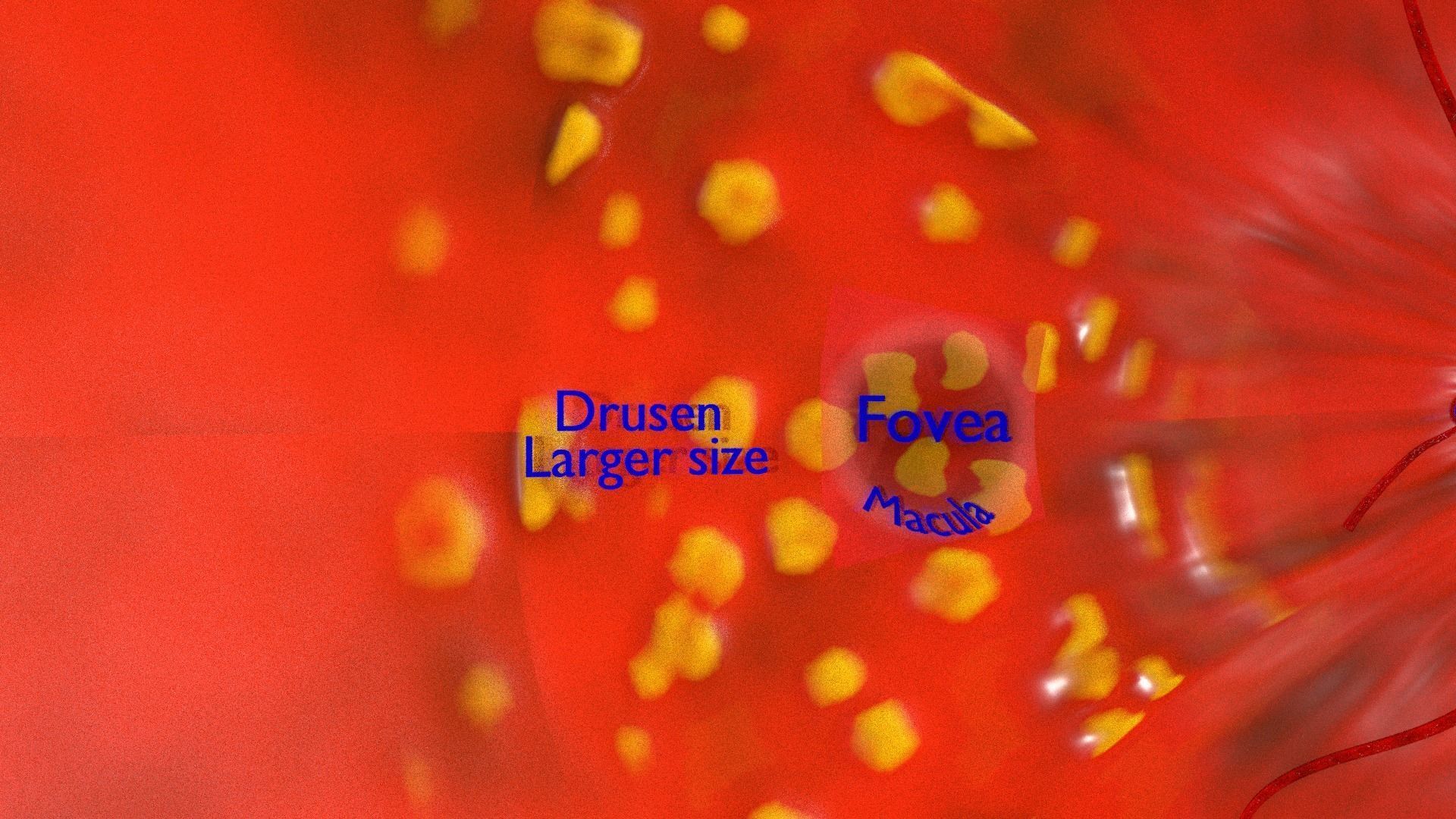 Age related macular degeneration AMD ARMD detailed labelled 3D model ...