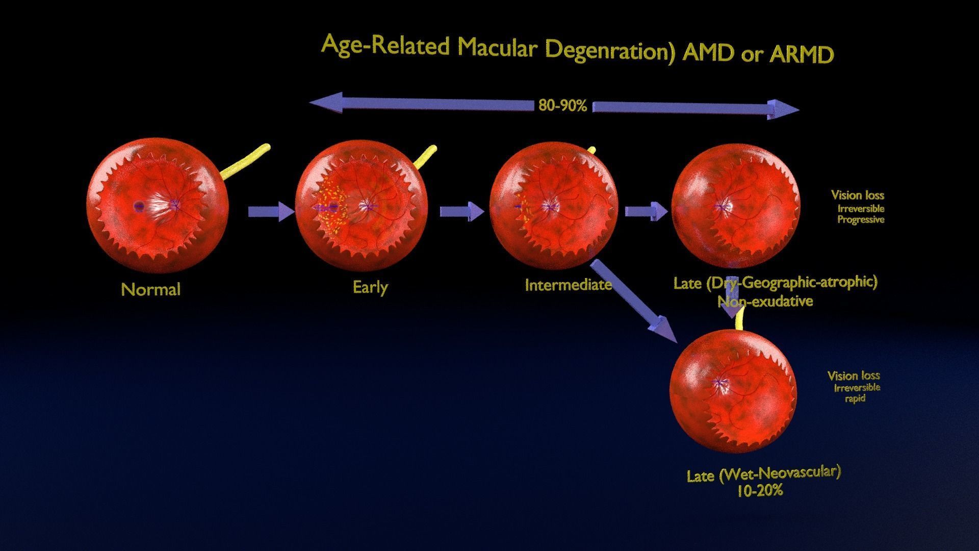 Age related macular degeneration AMD ARMD detailed labelled 3D model ...