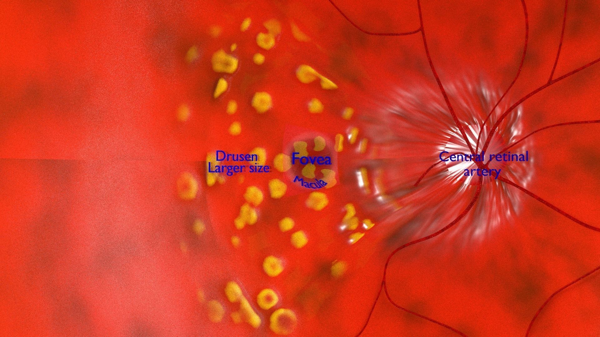 Age related macular degeneration AMD ARMD detailed labelled 3D model ...