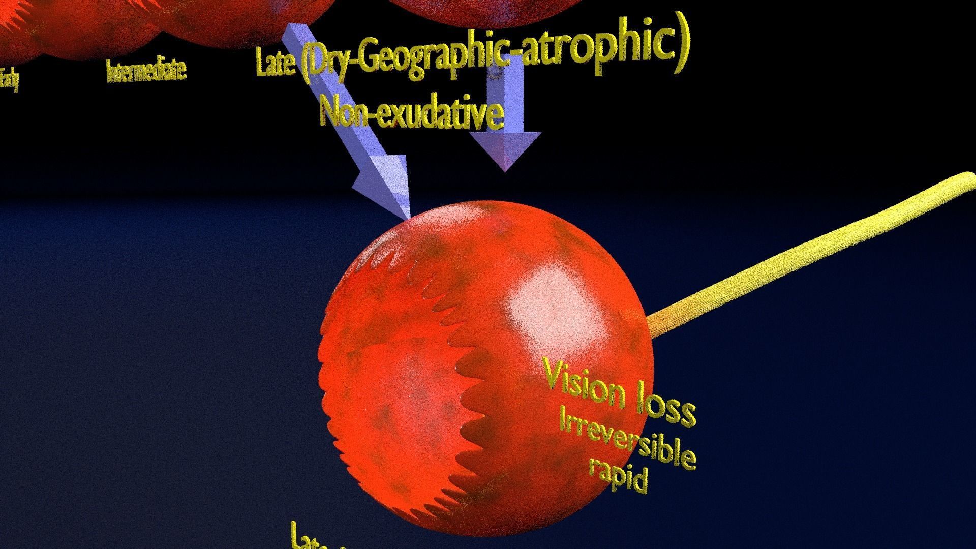 Age related macular degeneration AMD ARMD detailed labelled 3D model ...