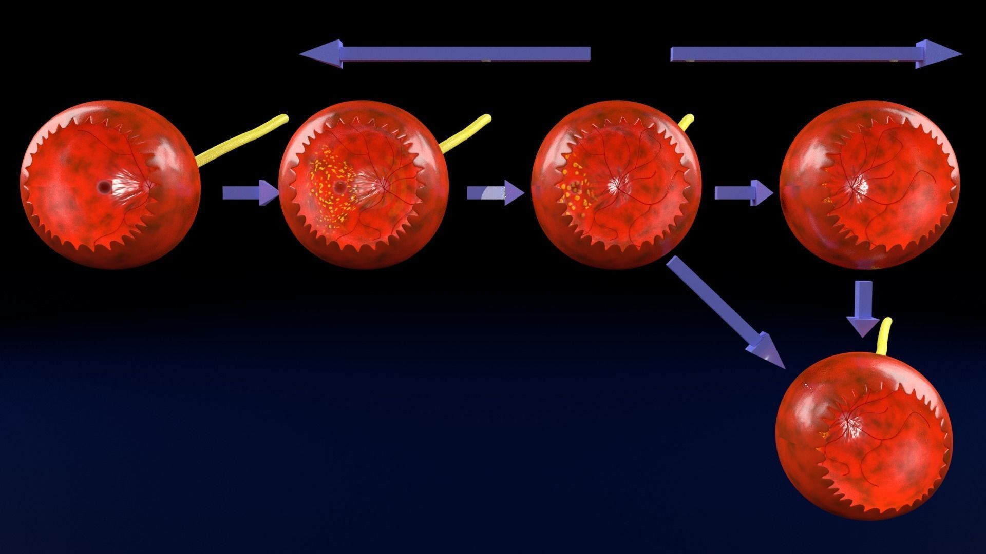 Age related macular degeneration AMD ARMD detailed labelled 3D model ...