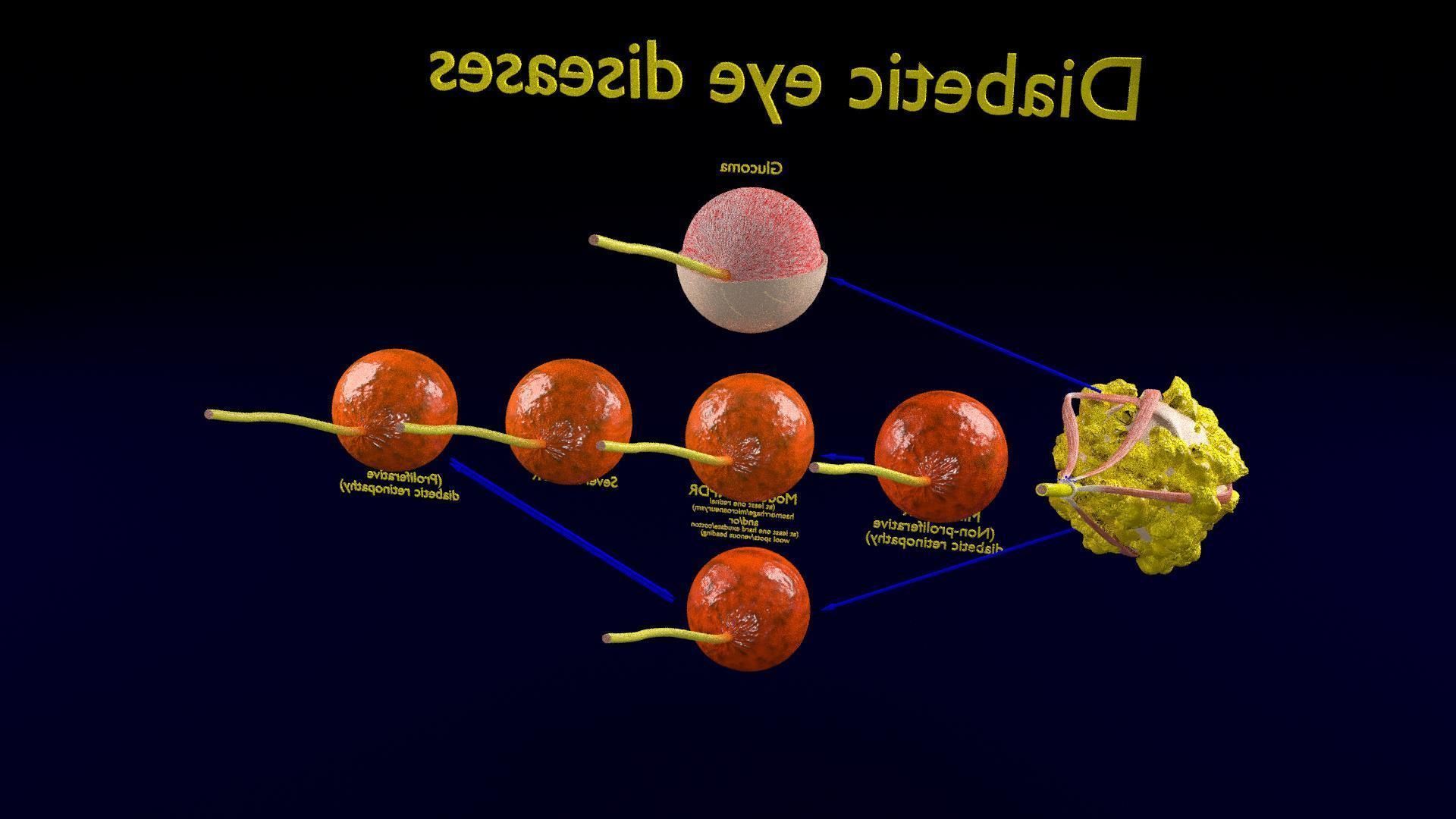 Diabetic eye diseases 3D model | CGTrader