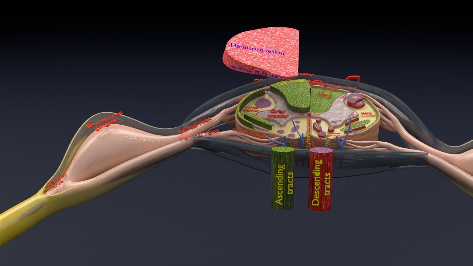 Spinal cord lesions and clinical signs and symptoms 3D model animated ...