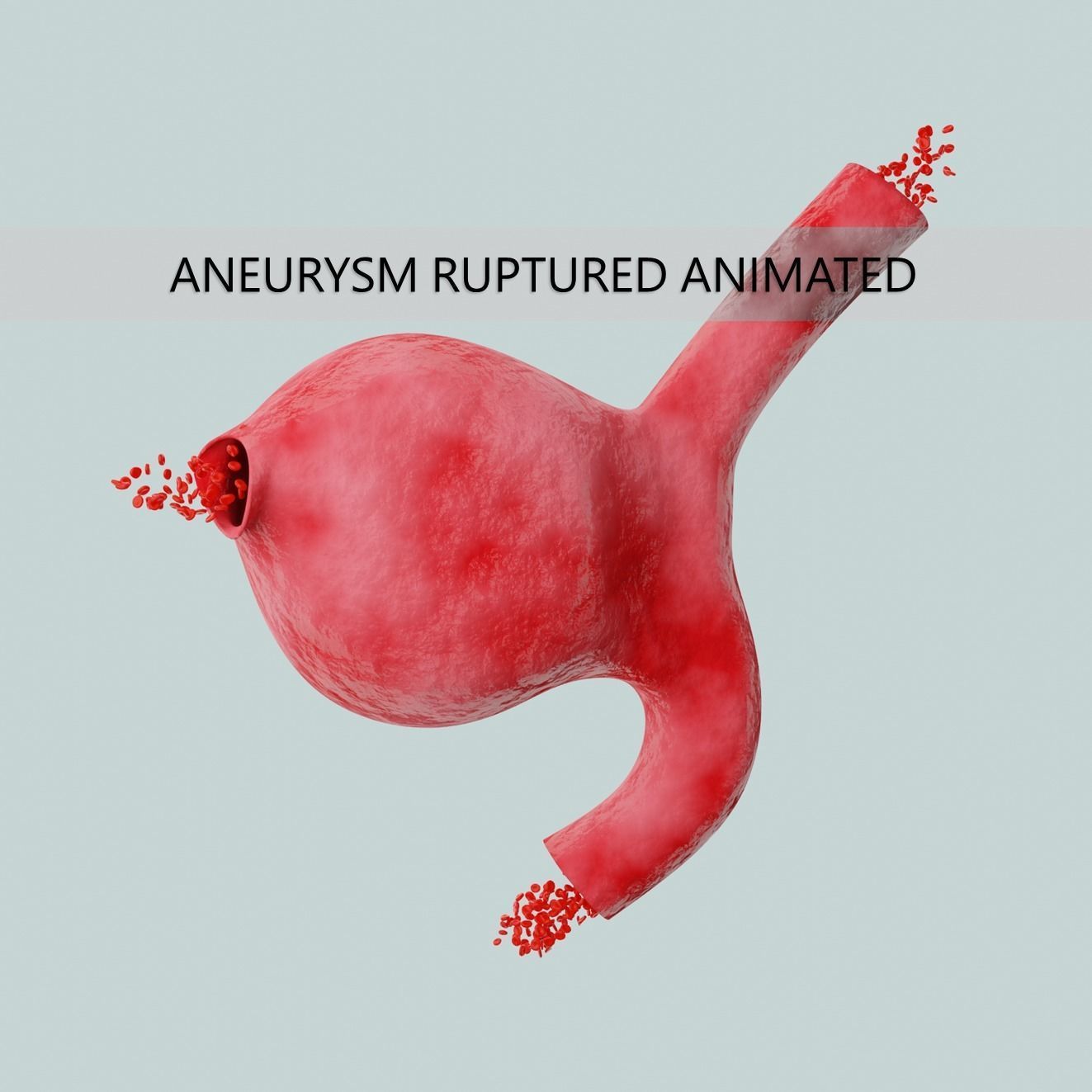 3D model Aneurysm ruptured photorealistic animated VR / AR / low-poly ...