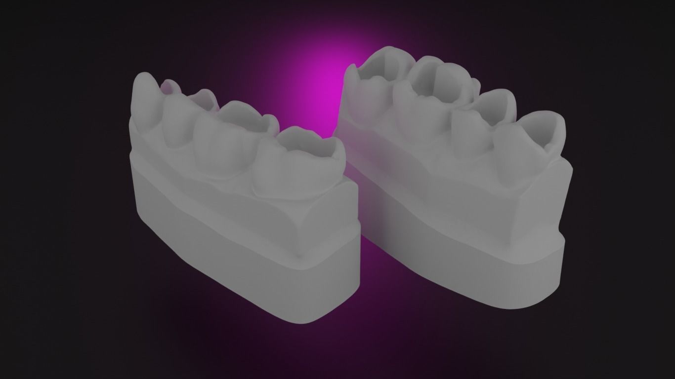 Guidline in composite filling 3D model 3D printable | CGTrader