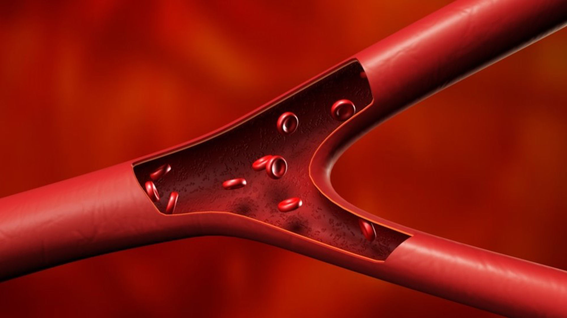 Clog Stream Bloodflow Layers Section Anatomy Artery Vein 3D model ...