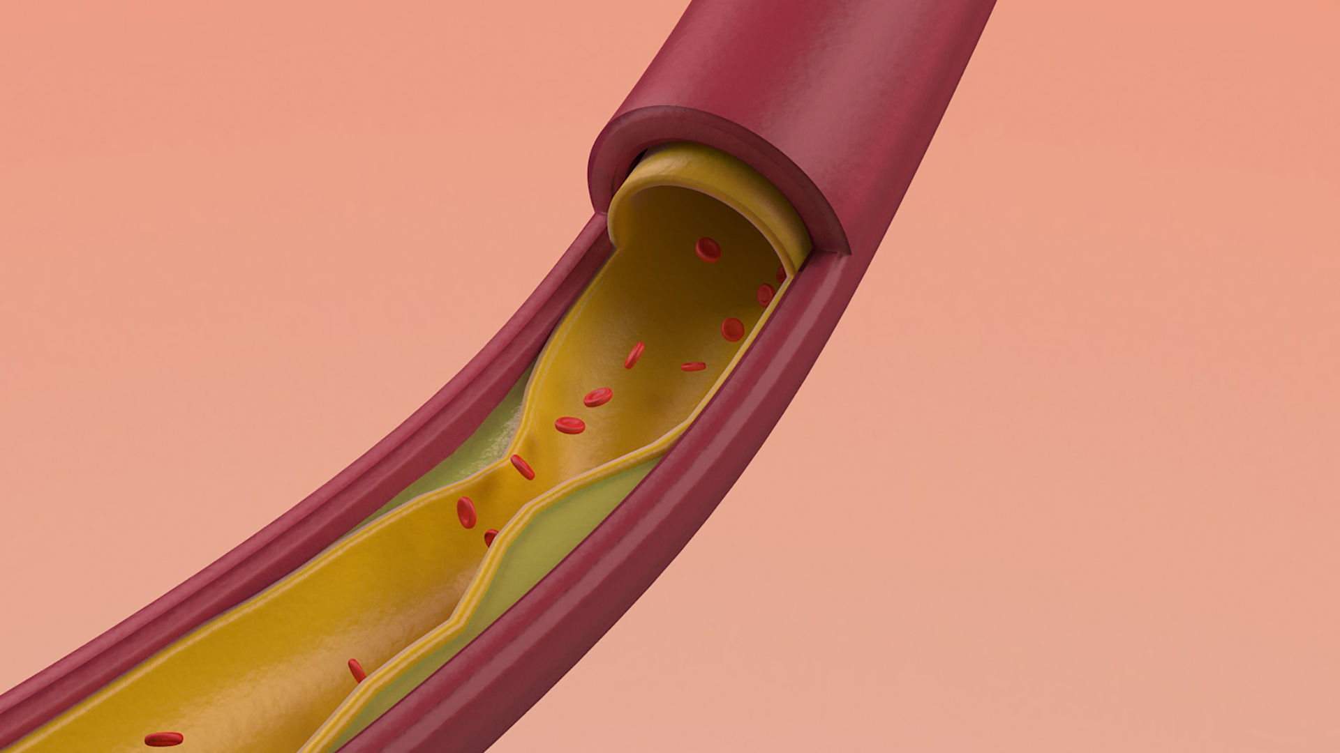 Artery Vein Clog Clot Clogged Stream Bloodflow Layers Section 3D model ...