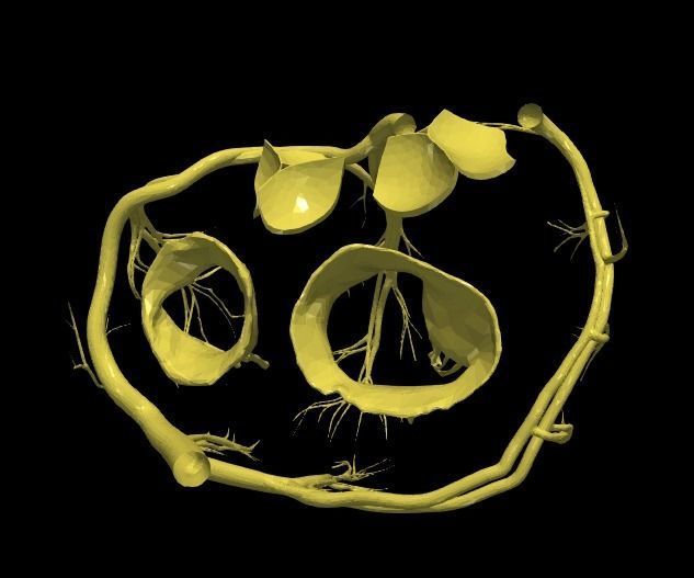 3D model of heart with transposition of the great arteries 3D model ...