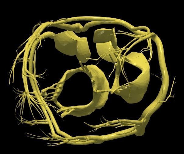 3D model of heart with transposition of the great arteries 3D model ...