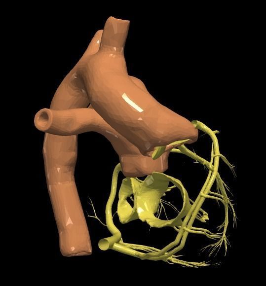 3D model of heart with transposition of the great arteries 3D model ...
