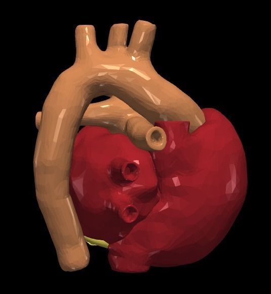 3D model of heart with transposition of the great arteries 3D model ...