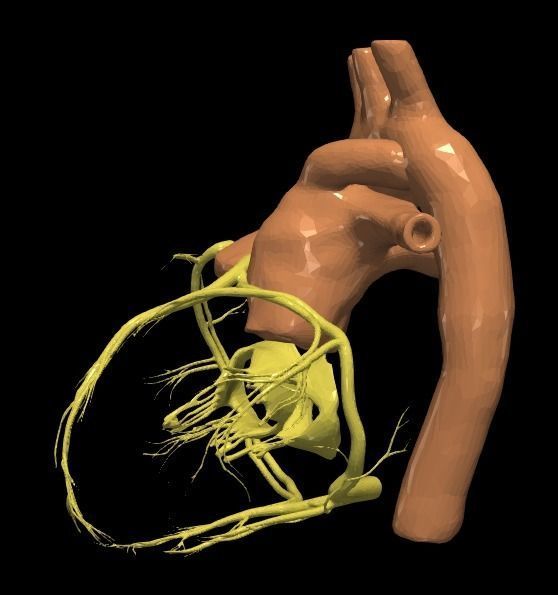 3D model of heart with transposition of the great arteries 3D model ...