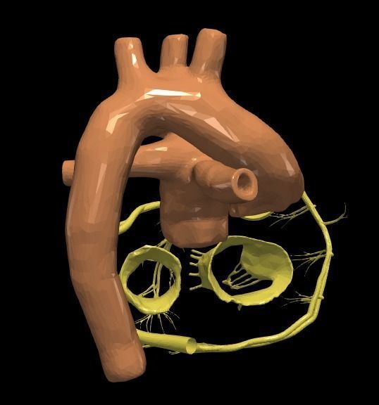 3D model of heart with transposition of the great arteries 3D model ...
