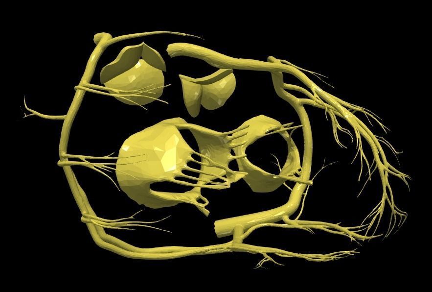 3D model of heart with transposition of the great arteries 3D model ...