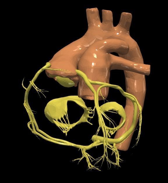 3D model of heart with transposition of the great arteries 3D model ...