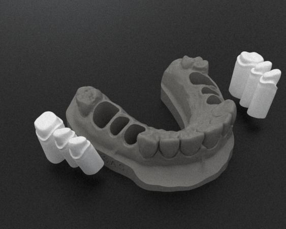 Dental Model wax-up 3D model 3D printable | CGTrader